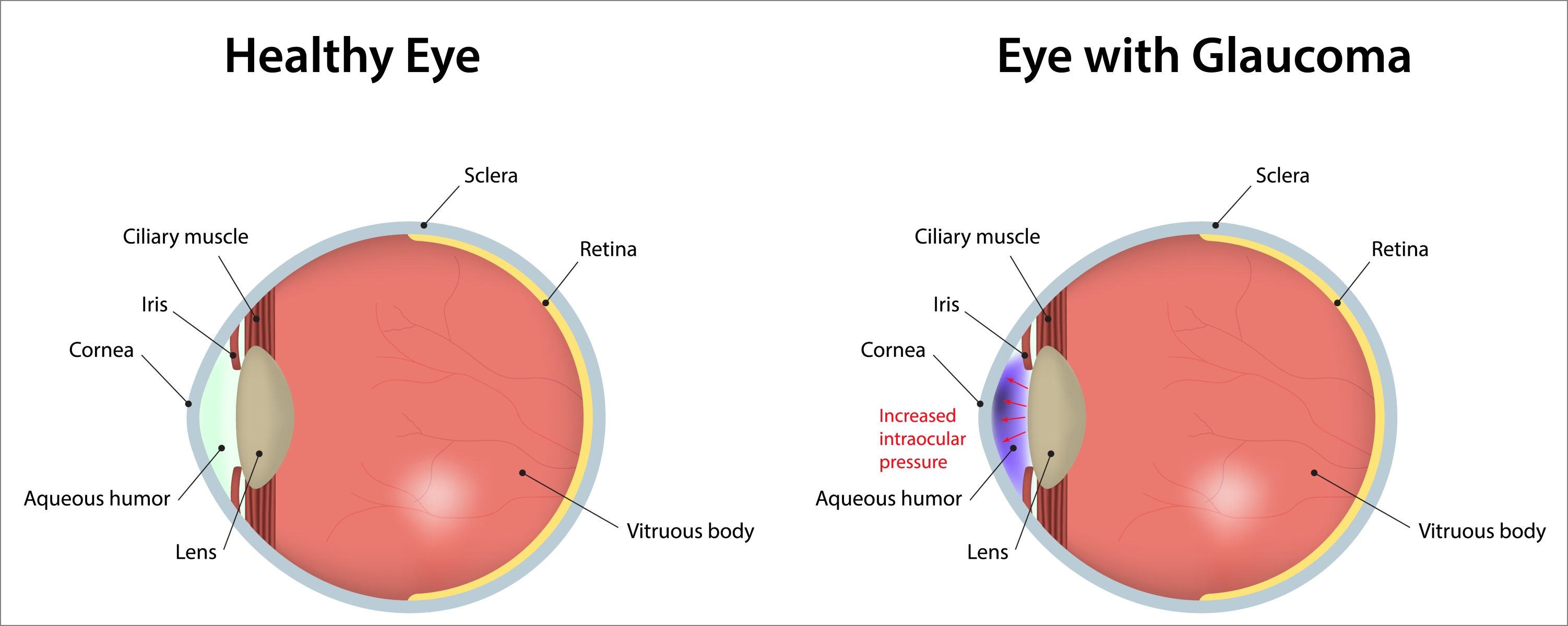 Glaucoma 10 Facts Everyone Should Know Optix Eye Care Glaucoma 10 Facts Everyone Should Know Optix Eye Care